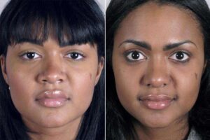 Flaring Nostrils – Surrey Medical Aesthetics