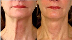 Platysmal neck bands – Surrey Medical Aesthetics